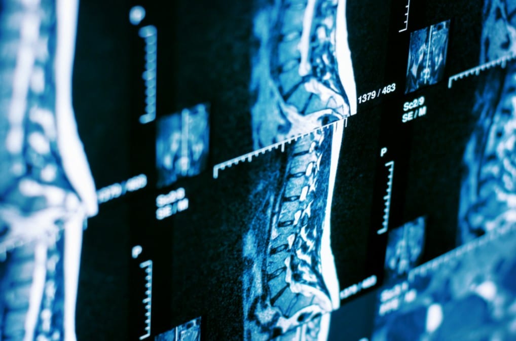 ¿Qué muestra una resonancia de columna y cuándo está indicada ...